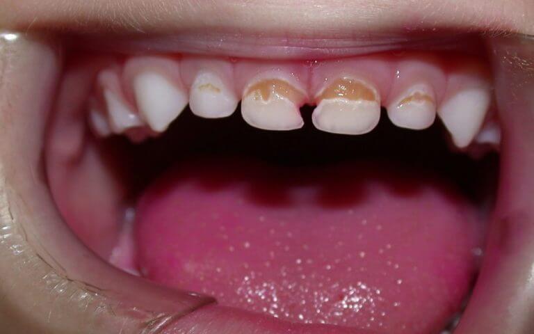 MI HIJO TIENE CARIES, ¿QUÉ HAGO? - Clinica Dental Fabián López para Ibi ...