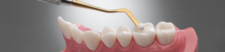 ¿QUÉ ES UN EMPASTE DENTAL? - Clinica Dental Fabián López